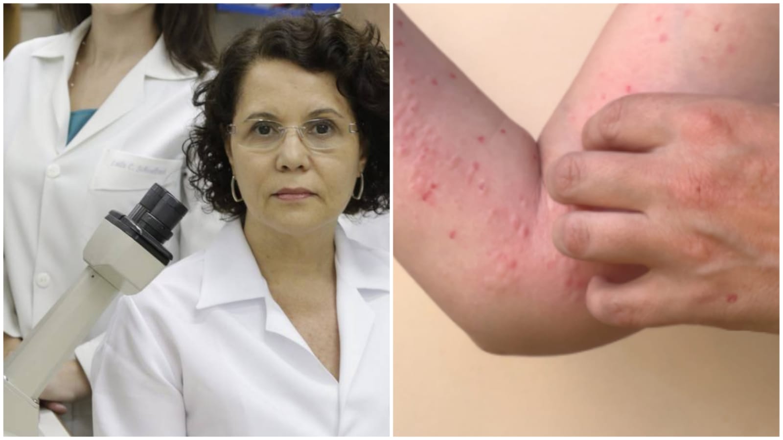 Varíola dos macacos: após confirmação do primeiro caso em Petrópolis ...